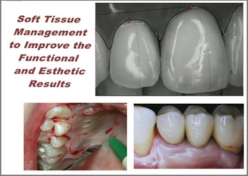 Advanced Implant Therapy: Soft Tissue Management - Dental Courses