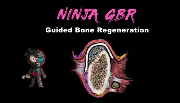 Implant Ninja, Guided Bone Regeneration - Dental Courses