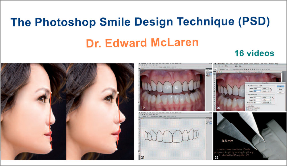 The Photoshop Smile Design Technique (PSD) - Dental Courses